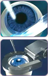 Custom Lasik Surgery - Kenia Eye Hospital